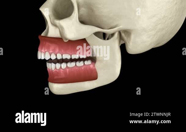 Overbite dental occlusion ( Malocclusion of teeth ). Medically accurate ...