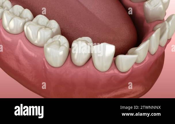 Abnormal teeth position, orthodontic concept. Medically accurate tooth ...