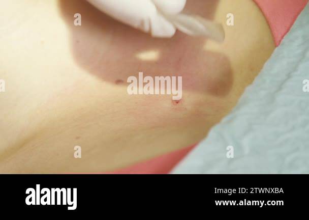 Close Up Unrecognizable Female Patient Having Birthmark Removed On The