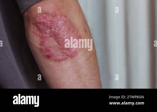 Skin plaques Stock Videos & Footage - HD and 4K Video Clips - Alamy