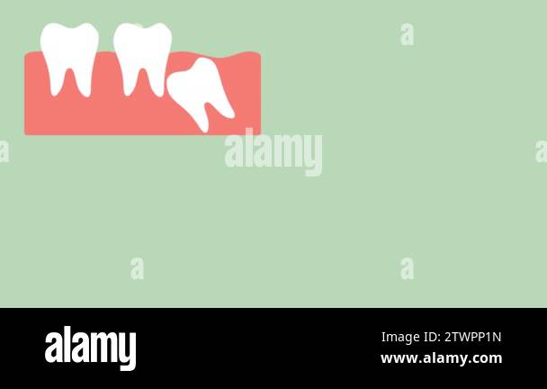 type of wisdom tooth - mesial impaction, distal impaction, horizontal ...