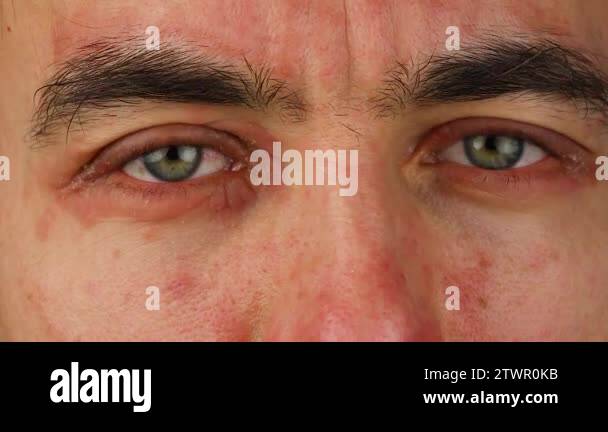 human scratches two of his eyes with red allergic reaction, redness and ...