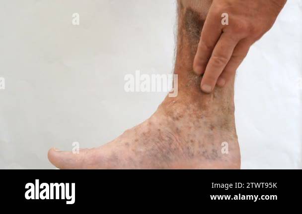 Illness of the human skin. A person s hands touch and scratch scars ...