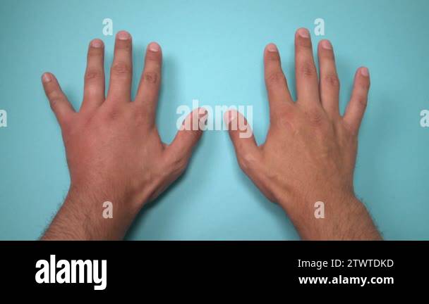 Comparison of two male hands stung by bee or wasp. Hand swelling ...