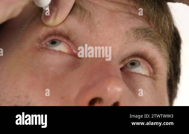 eye inflamnmation after hard work at the computer, man dripping liquid ...