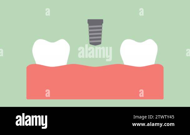 dental implant, installation process and change of teeth - tooth ...