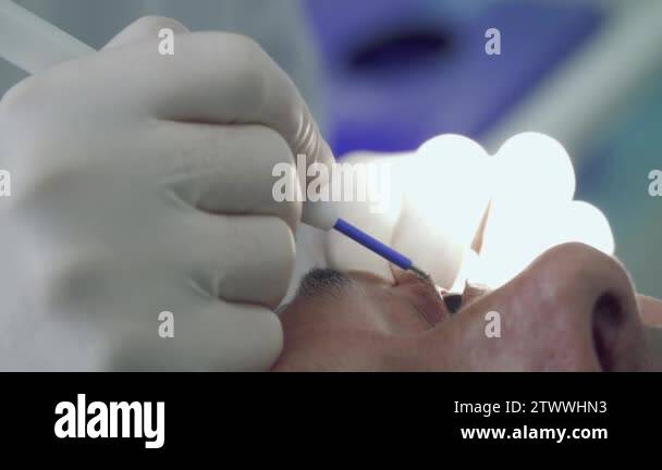Dermatologist burning mole with laser on the eyelid of man Stock Video ...