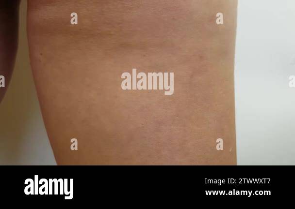 Lipodystrophy Stock Videos & Footage - HD and 4K Video Clips - Alamy