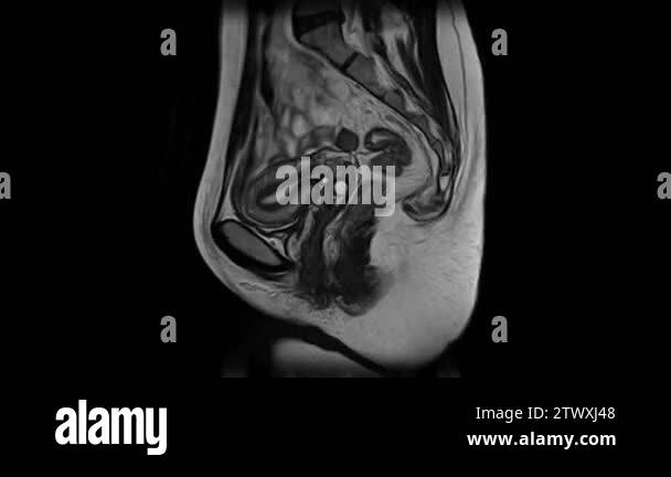 Contrast MRI scan of the abdominal cavity and retroperitoneal space ...