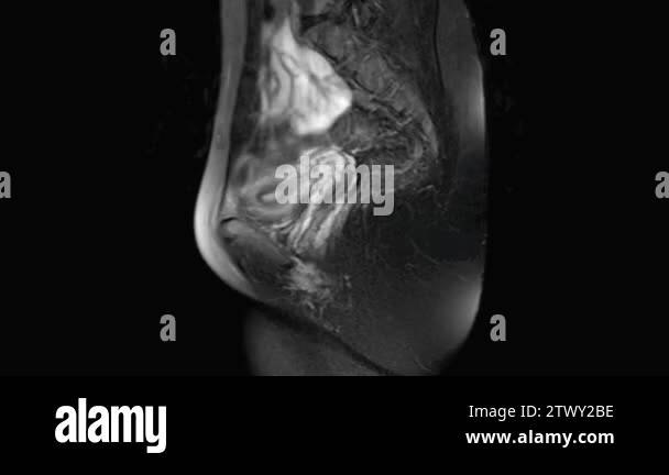 Contrast MRI scan of the abdominal cavity and retroperitoneal space ...