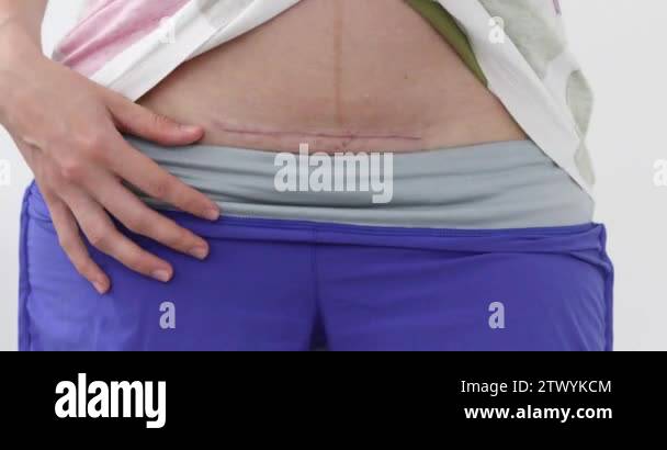 Cesarean section scar Stock Videos & Footage - HD and 4K Video Clips - Alamy