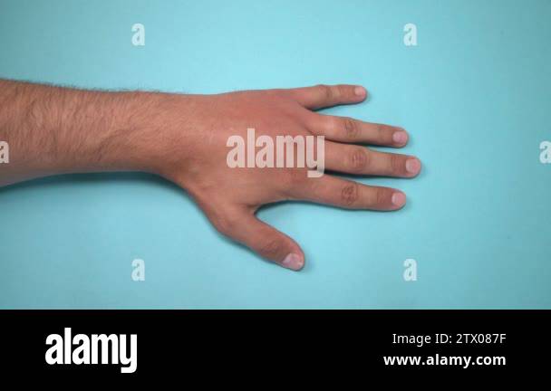 Male hand stung by bee or wasp. Hand swelling, inflammation, redness ...
