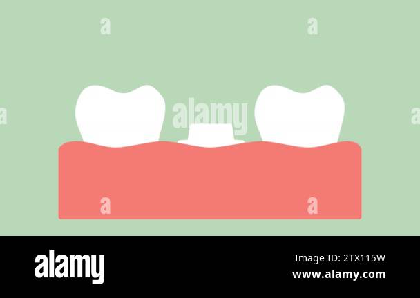 dental crown, installation process and change of teeth - tooth cartoon ...