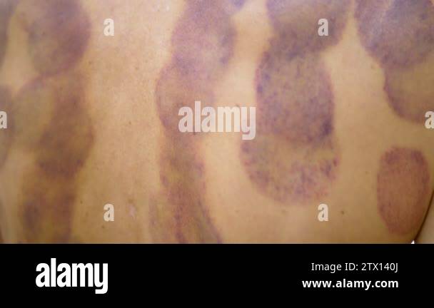 Round bruises. Traces on the back of a young woman after the procedure ...