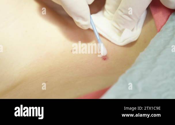 Bleeding cut skin Stock Videos & Footage - HD and 4K Video Clips - Alamy