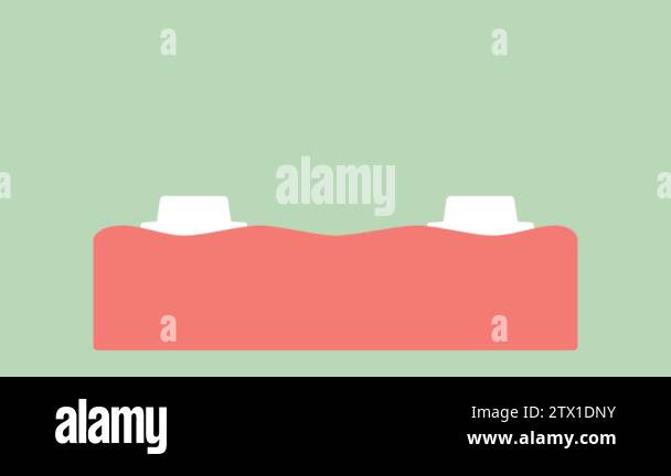 dental crown with bridge, installation process and change of teeth ...