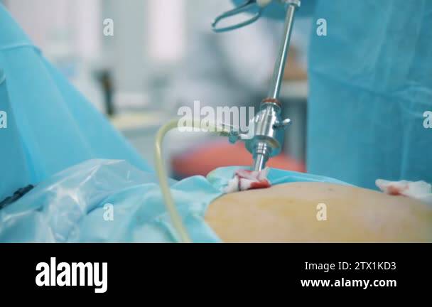 Abdominal procedure Stock Videos & Footage - HD and 4K Video Clips - Alamy