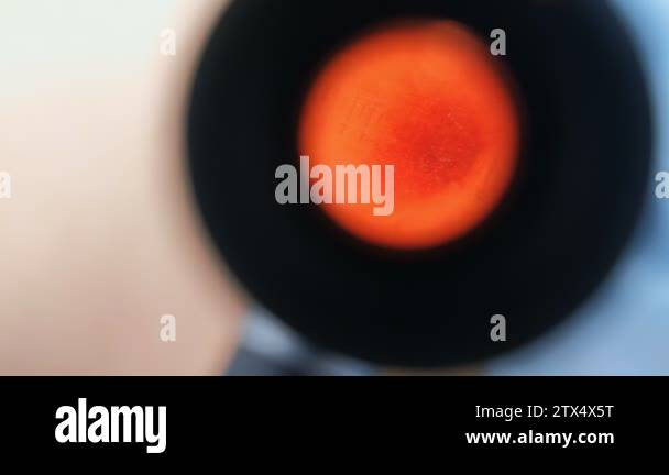 Mole with dermatoscope view Stock Videos & Footage - HD and 4K Video ...