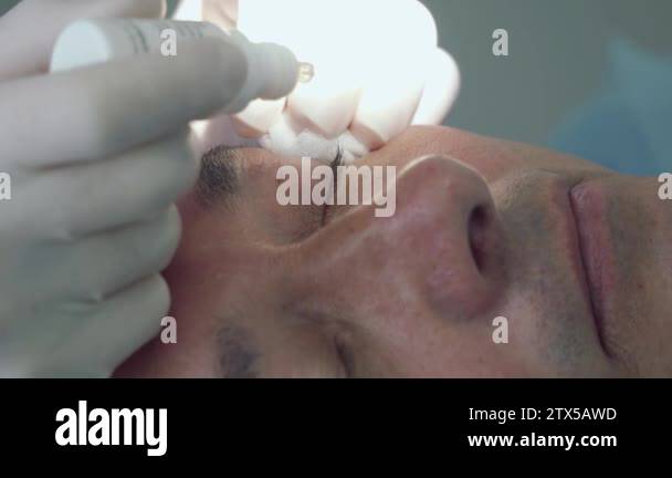 Doctor drip drops on eyelid of patient and anesthetizes skin before ...