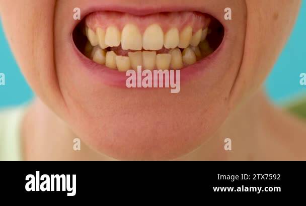 Bad set of teeth Stock Videos & Footage - HD and 4K Video Clips - Alamy