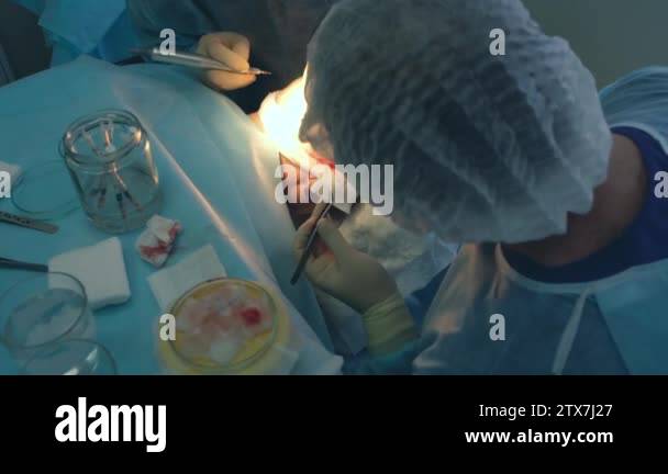 Baldness treatment. Hair transplant. Surgeons in the operating room ...