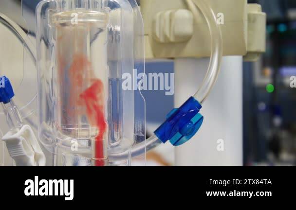 Dialysis machine blood filling Stock Video Footage - Alamy