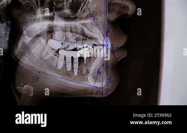 Teleradiography Stock Videos & Footage - HD and 4K Video Clips - Alamy