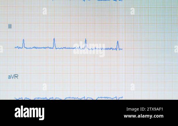 Abnormal ecg Stock Videos & Footage - HD and 4K Video Clips - Alamy