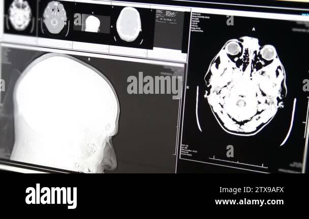 A doctor examines a head MRI scan on a computer screen Stock Video ...
