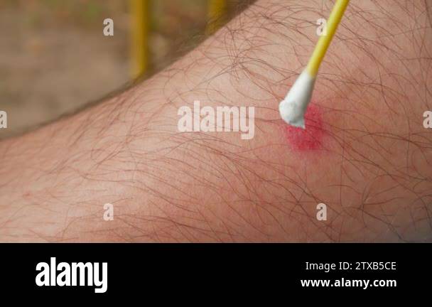 Leg damage Stock Videos & Footage - HD and 4K Video Clips - Alamy