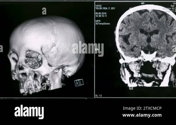 3D model of a human brain case shown on a screening monitor Stock Video ...
