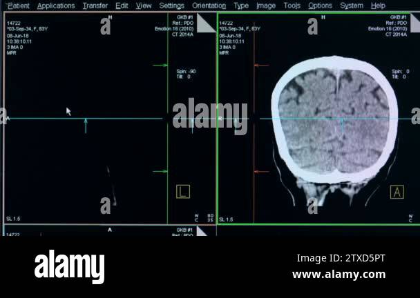 Depiction of a human brain case is being shown on a scanning monitor Stock Video Footage - Alamy