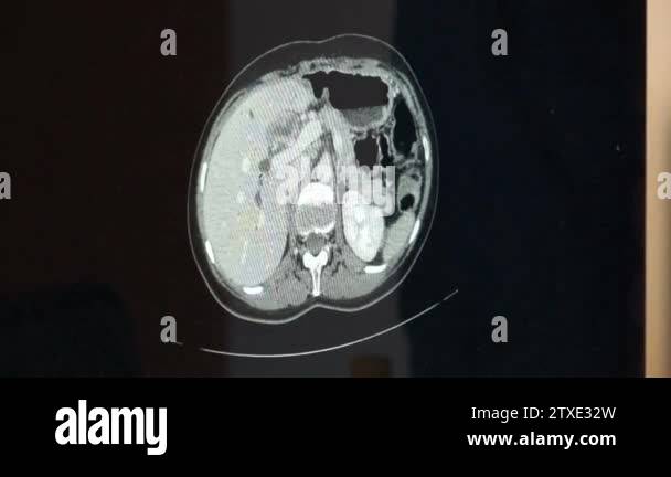 Three head views of MRI scan, MRI brain scan on black background ...