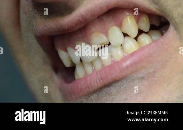 Broken tooth. Broken upper incisor in a man mouth. Man shows oral ...