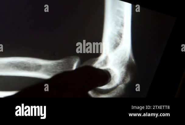 4k doctors study arm,leg&palm joints skeleton bone X-ray film for ...