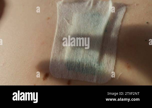 Peeling the patch on scar after removal of surgical sutures. Large ...