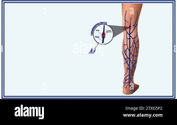 Chos Thrombophlebitis Superficial