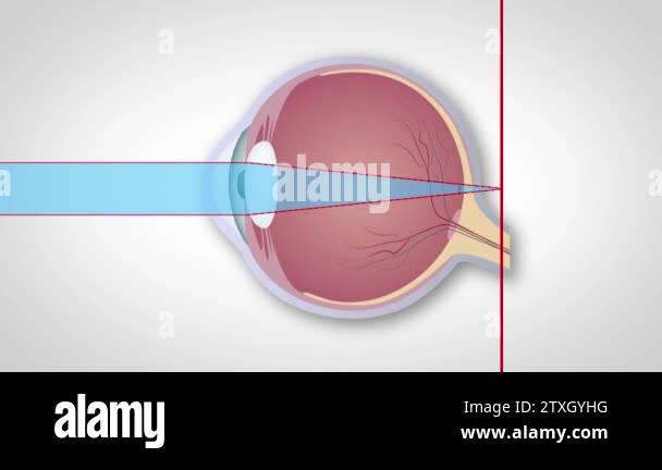 Schematic representation of hyperopia, myopia and astigmatism ...