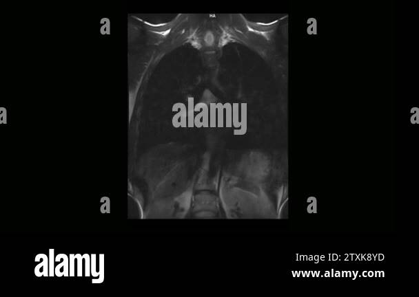 Computed medical tomography MRI scan of the thoracic spine of a man ...