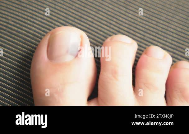 Sick nail. Trauma to the nail. Toes for legs. Bruise under the thumb ...