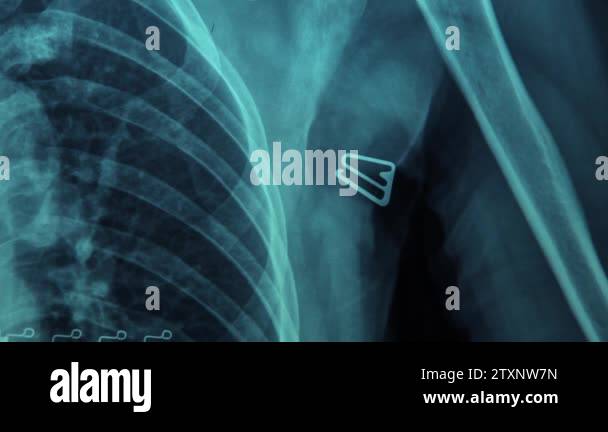 MRI Scan Broken Collar Bone (Broken Clavicle), Human Body Xray Monitor ...