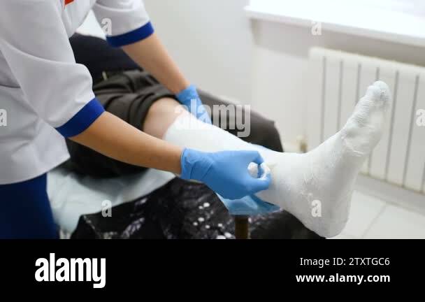 doctor traumatologist puts a plaster on the broken leg of the patient ...