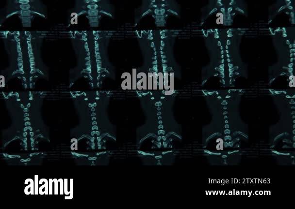 Vertebral column, Spine, MRI Scan, Human Body Xray Monitor Stock Video ...