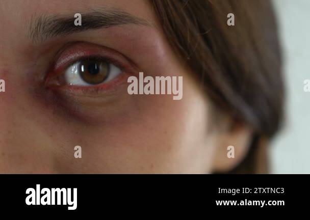 Female bruised eye Stock Videos & Footage - HD and 4K Video Clips - Alamy