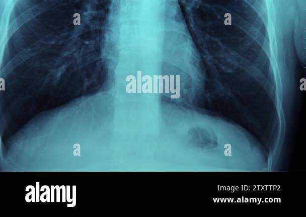 MRI Scan Broken Collar Bone (Broken Clavicle), Human Body Xray Monitor ...