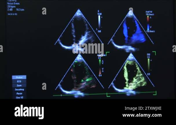 Cardiac Ultrasound Stock Video Footage - Alamy