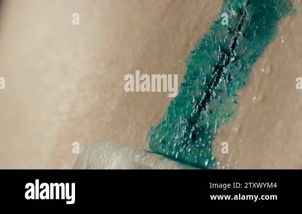 Covering scar after removal of surgical sutures with brilliant green ...