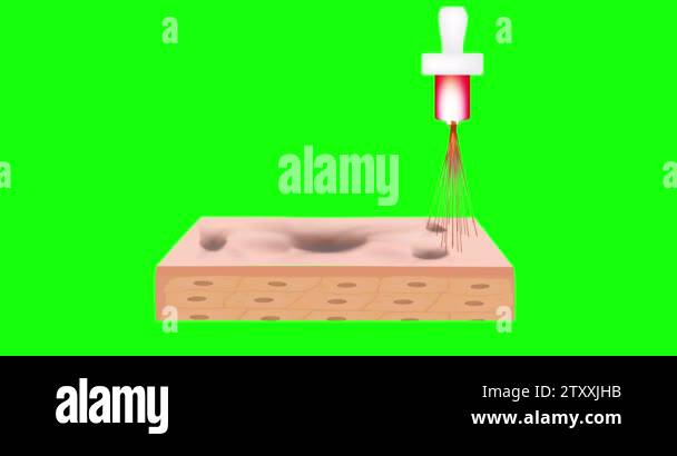 Animation of laser acne scar treatment. Laser resurfacing of skin with ...