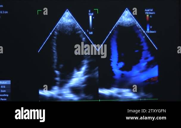 Cardiac ultrasound Stock Videos & Footage - HD and 4K Video Clips - Alamy
