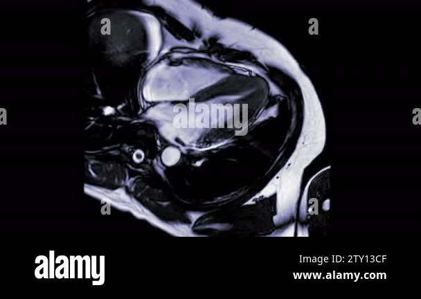 MRI heart or Cardiac MRI magnetic resonance imaging of heart in 4 ...